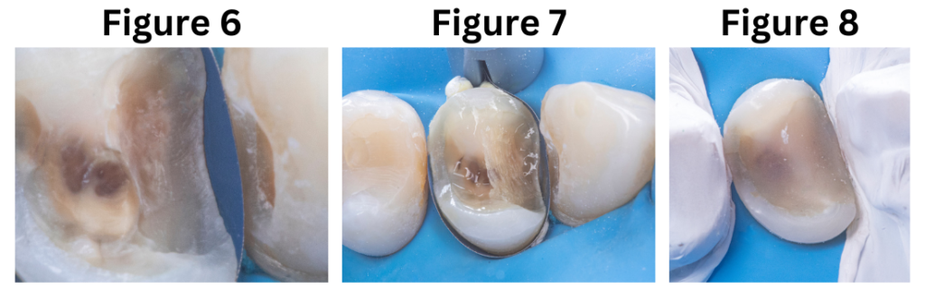 Dr Patricio Guitierrez Case Study: Clinical Management of Deep ...